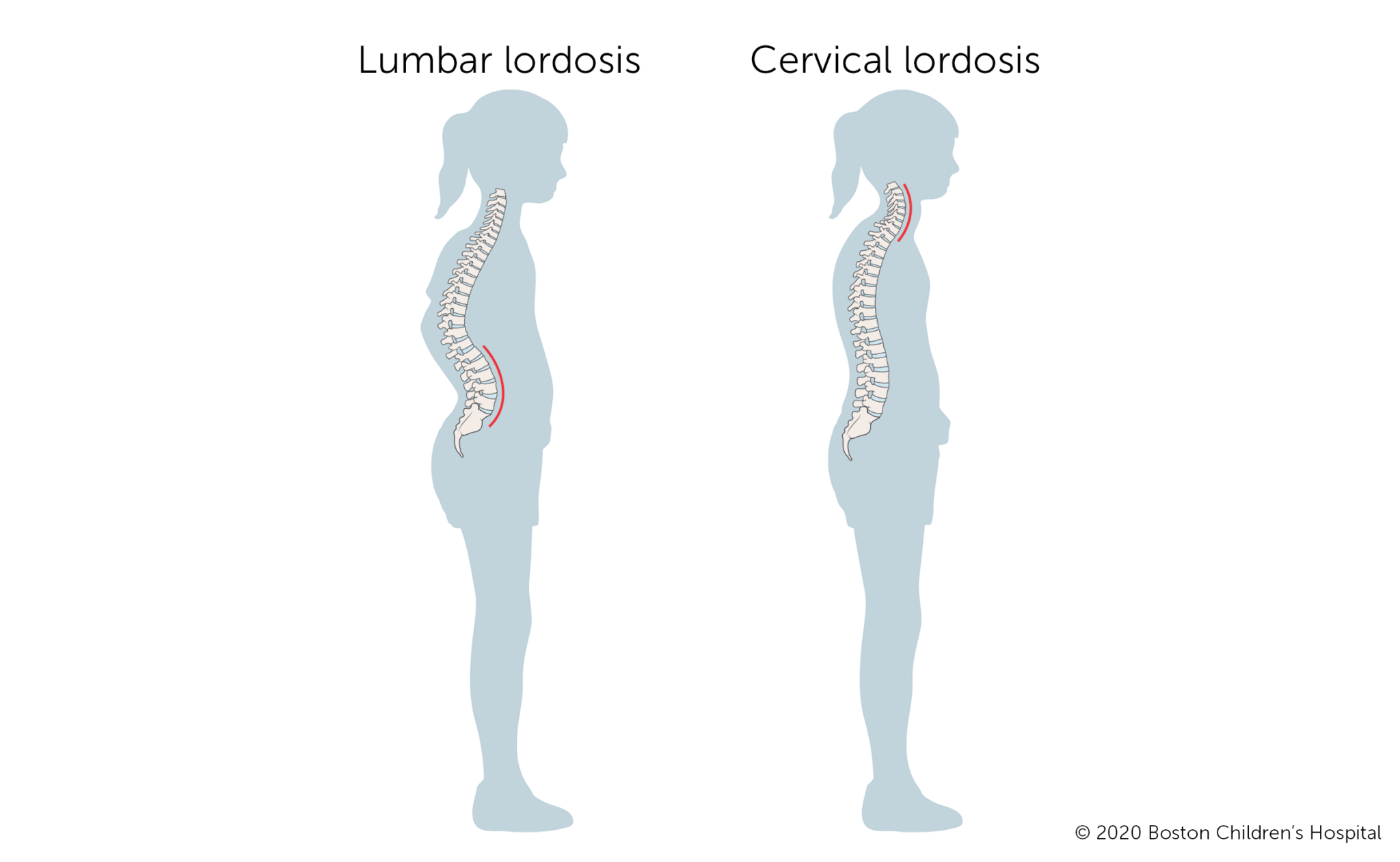 Chairs for People with Lordosis - Vivid Care
